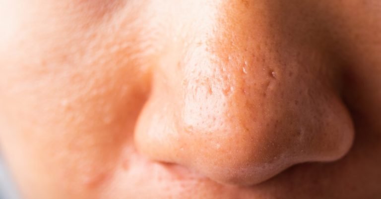 How to Shrink Large Nose Pores Naturally